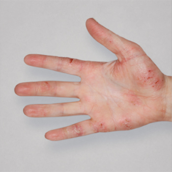 Adult IGA Efficacy Results | DUPIXENT® (dupilumab)