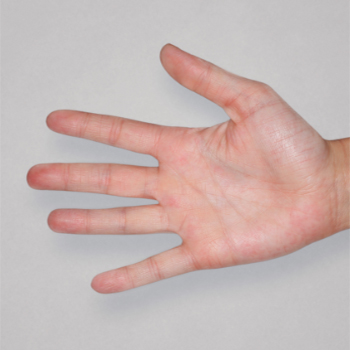 Adult IGA Efficacy Results | DUPIXENT® (dupilumab)